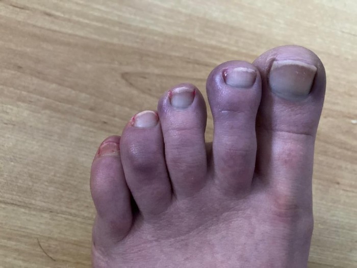 What Does Raynaud's Disease Look Like? - RaynaudsDisease.com