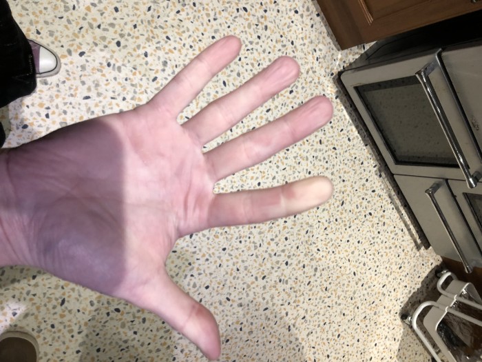 What Does Raynaud's Disease Look Like? - RaynaudsDisease.com