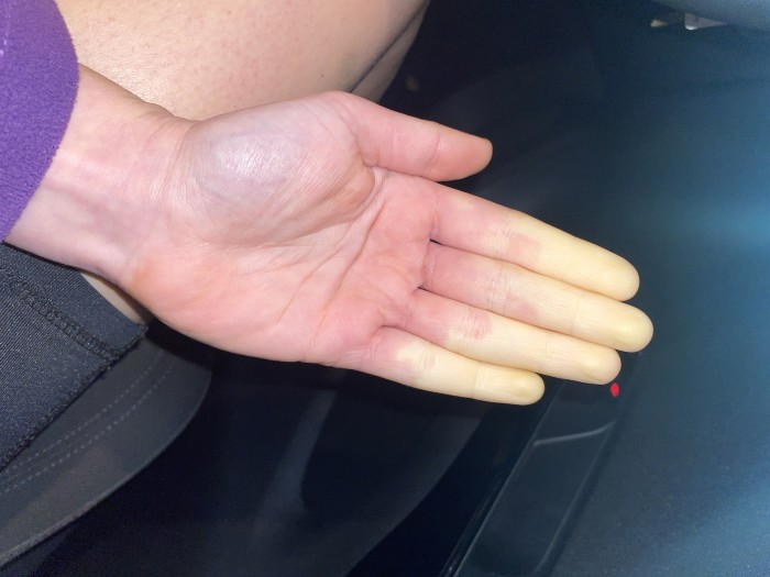 What Does Raynaud's Disease Look Like? - RaynaudsDisease.com