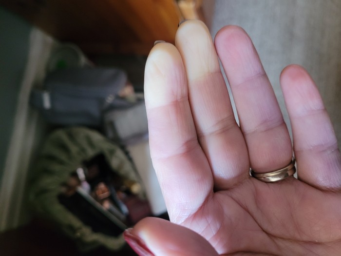 What Does Raynaud's Disease Look Like? - RaynaudsDisease.com