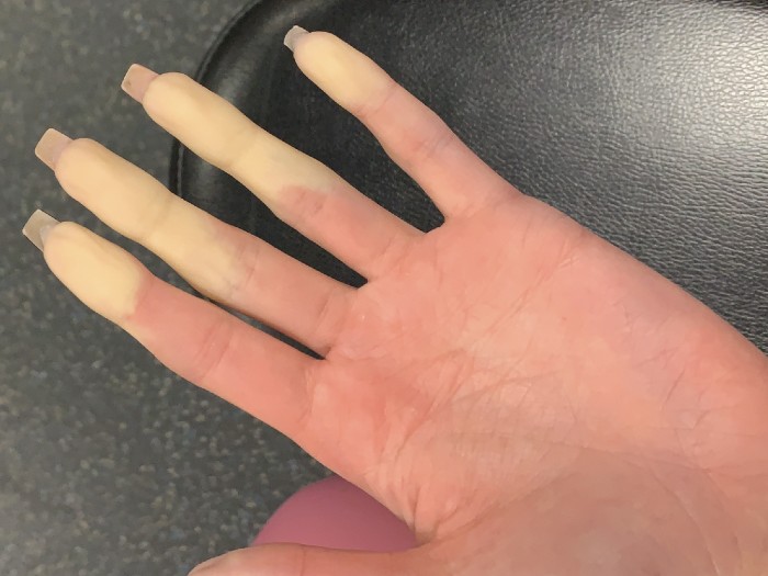 What Does Raynaud's Disease Look Like? - RaynaudsDisease.com