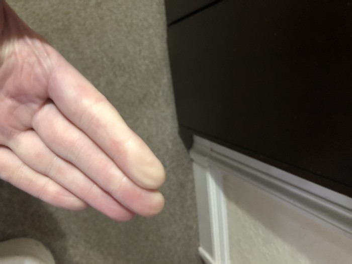 What Does Raynaud's Disease Look Like? - RaynaudsDisease.com